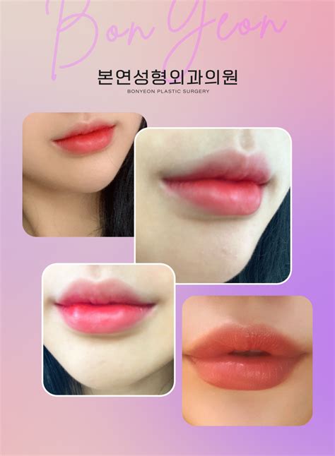 본연 레스틸렌 필러 1cc 체험가 By 본연성형외과의원 강남언니 1등 성형수술and피부시술 정보앱