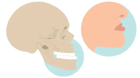 Bone Reshaping Surgery Osteotomy