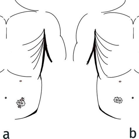 The Site Of Temporary Ileostomy A Sses B Sns Sses Stoma Through The