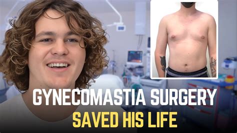 Gynecomastia Surgery Saved His Life Youtube