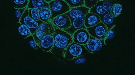Mercks Keytruda Qlex™ Secures Fda Approval As First Subcutaneous
