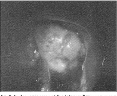 Figure 3 From Ectopic Third Molar In Maxillary Sinus Semantic Scholar