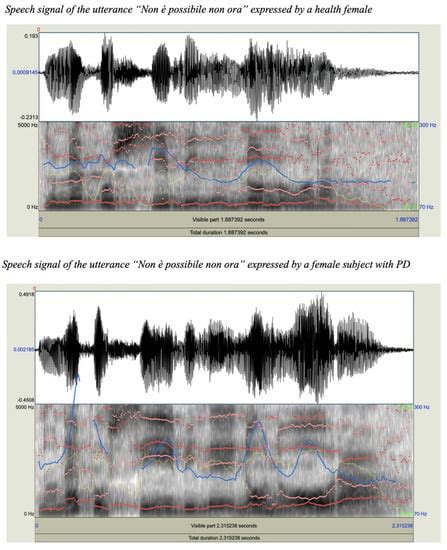Vocal Emotional Expression In Parkinsons Disease Roles Of Sex And