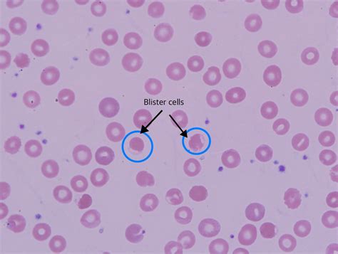 Blister Cells On Peripheral Smear