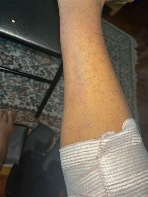 Is This Bruising Normal 11 Days Post Op Hamstring Graft Racl