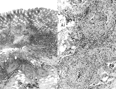 Autoimmune And Septic Vasculitis In The Gastrointestinal Tract A