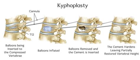 Kyphoplasty Treatment For Spinal Compression Fractures Your Health Magazine