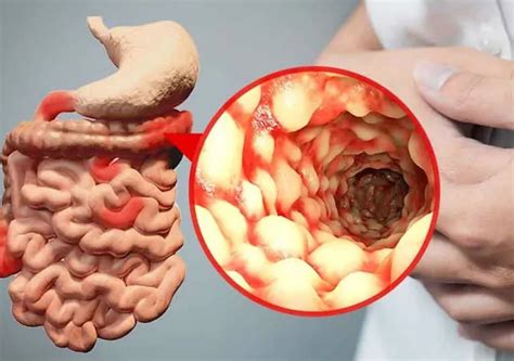 Que Es La Enfermedad De Crohn Diferencias Entre Colitis Ulcerosa Y