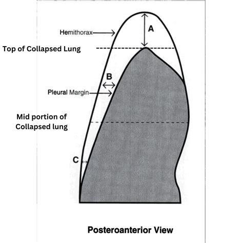 Pneumothorax Percentage Calculator Radiogyan
