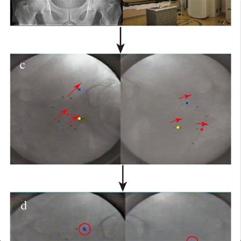 Example Of Fiducial Marker Registration A X Ray Of Patient Abdomen