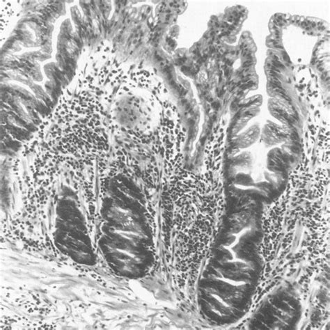 Hyperplastic Mucosa The Epithelium Shows Tall Columnar Cells With A