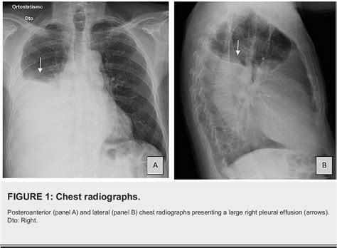 Figure 1 From A Gelatinous Pleural Effusion As A Diagnostic Clue