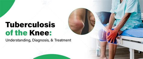 Knee Tuberculosis Signs Diagnosis And Treatment Explained