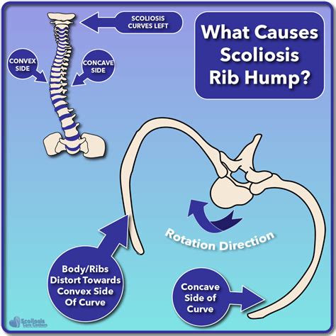 Levoscoliosis Vs Dextroscoliosis Gasc