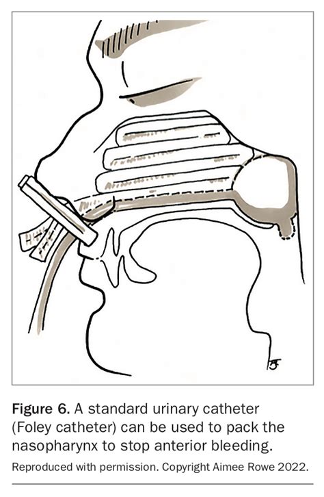 Managing Epistaxis A Guide For Gps Medicine Today