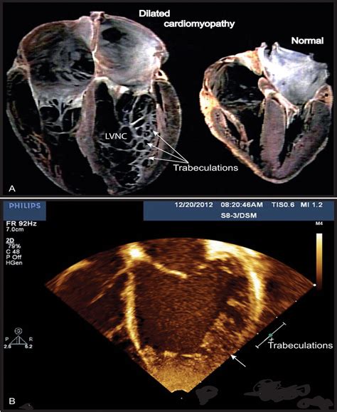 Left Ventricular Non Compaction Lvnc Associated With A Dilated Download Scientific Diagram
