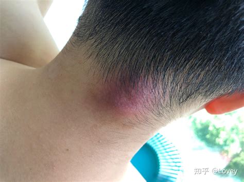 记一次疖肿 痈 切开引流手术经历 知乎