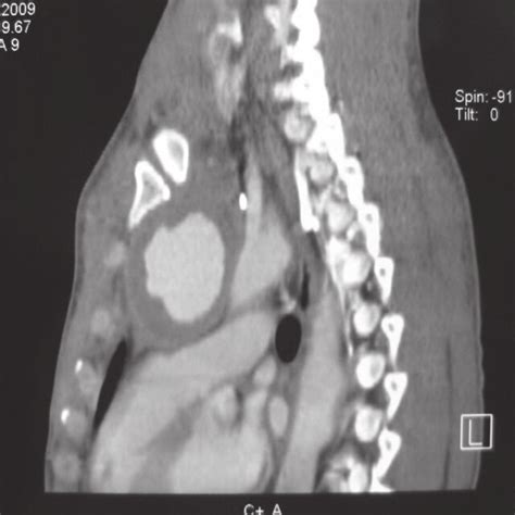 Arteriography Of Saccular Aneurysm On Ascending Aorta In 2009