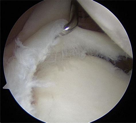 Injuries Of The Biceps And Superior Labral Complex In Overhead Athletes