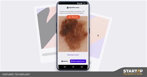 Skin Lesion Detection And Diagnosis