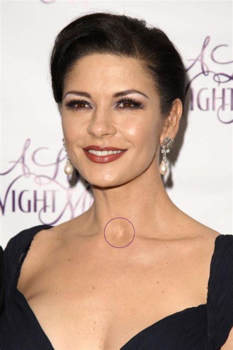 Celebrity Thyroid Surgery Scar