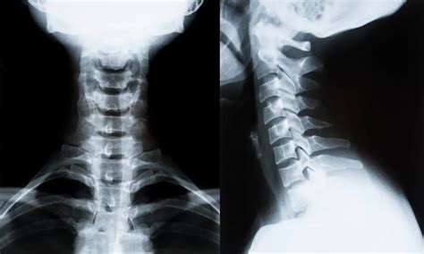 Female Abnormal Cervical Spine X Ray Xsstat