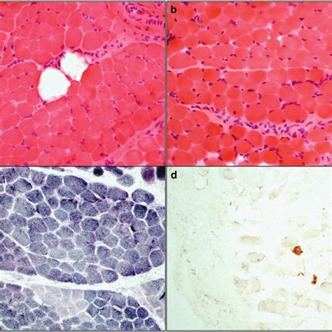 Pdf Recessive Piezo2 Stop Mutation Causes Distal Arthrogryposis With
