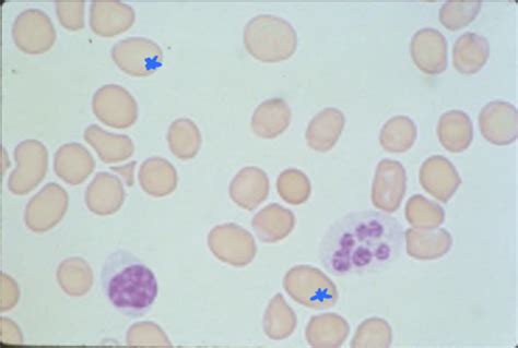 Macrocytic Anemias Megaloblastic And Non Megaloblastic Flashcards Quizlet