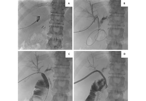 Balloon Dilation Of Post Hepaticojejunostomy Stricture A Initial