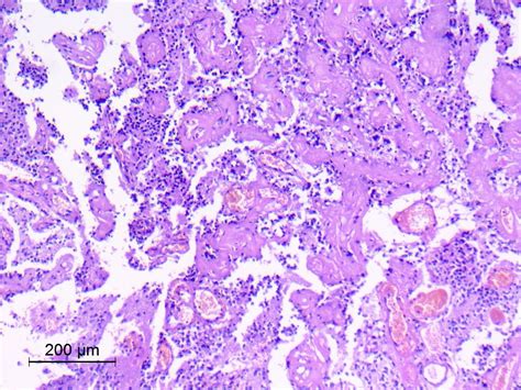 Cancer Cancerresearch Curingcancernetwork Pathology Curing Cancer