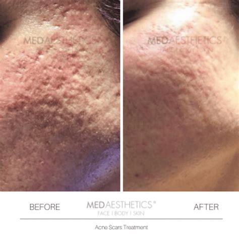 Subcision For Scars And Cellulite Medaesthetics