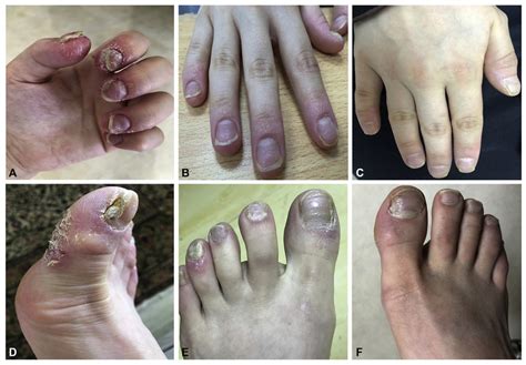 A 23 Year Old Woman With Acrodermatitis Continua Of Hallopeau Presented Download Scientific
