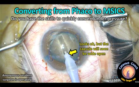 Anterior Vitrectomy Cataract Coach