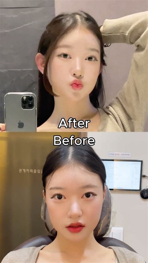 Girin Plastic Surgery Official🦒 Girin Eng • Instagram Photos And Videos