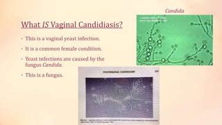 Brandy Goudreau Vaginal Candidiasis Pptx