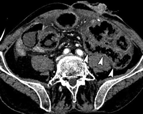 Contrast Enhanced Ct For The Diagnosis Of Acute Mesenteric Ischemia Ajr