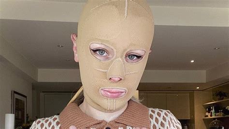 Woman Left With Severe Burns On 70 Percent Of Her Body And Had Eight