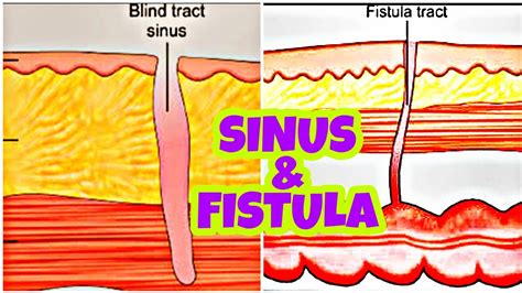 Easy Dentistry Sinus And Fistula Sinus And Fistula Description In