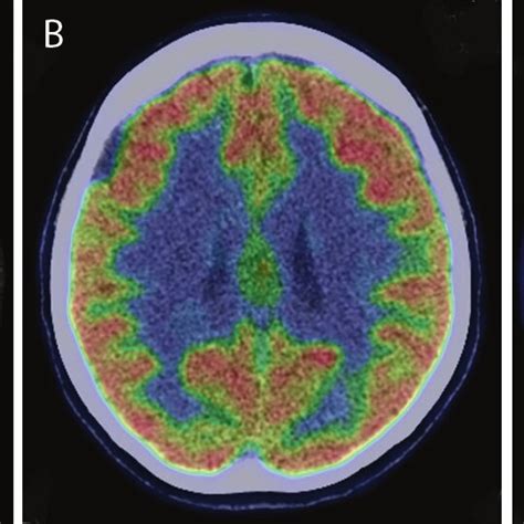 A 62 Year Old Female With Limbic Encephalitis Case 5 Flair Mri A