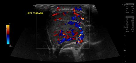 Forearm Inflammatory Intramuscular Collection Sonohive