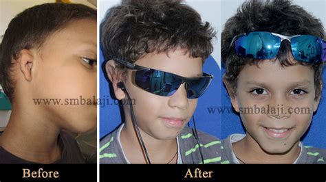 Microtia Ear Deformity Correction Ear Reconstruction India Best Dental Clinic In Chennai