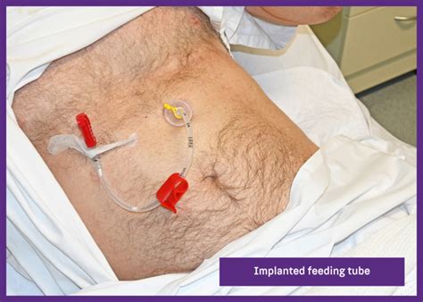 How To Manage Feeding Tubes What You Need To Know Zaggocare