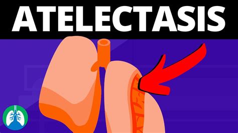 Atelectasis Medical Definition Quick Explainer Video Youtube