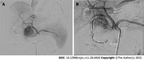 Angiography And Transcatheter Arterial Embolization Case 1 A