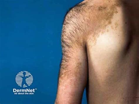 Becker Naevus Tattoos