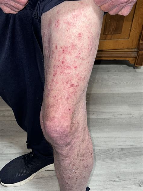 Elderly Father Chronic Rash Rdermatologyquestions