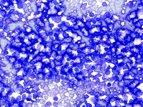 11 Atypia Of Undetermined Significance Aus This Aspirate Shows A