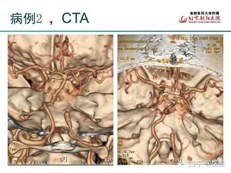 延髓背外侧综合征 知乎