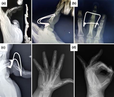 Male Patient Aged 42 Years Presented With Comminuted Pipj Fracture