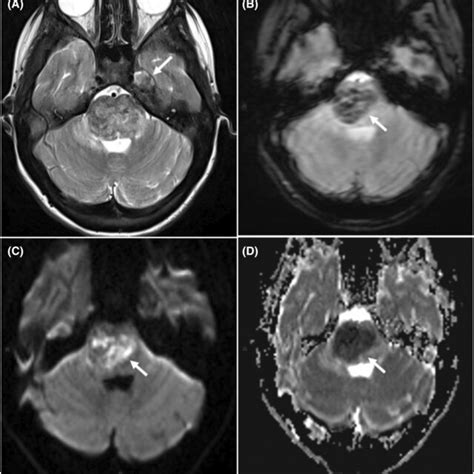 Mri Work‐up At Admission Two Axial Transverse Slices In Similar Slice Download Scientific